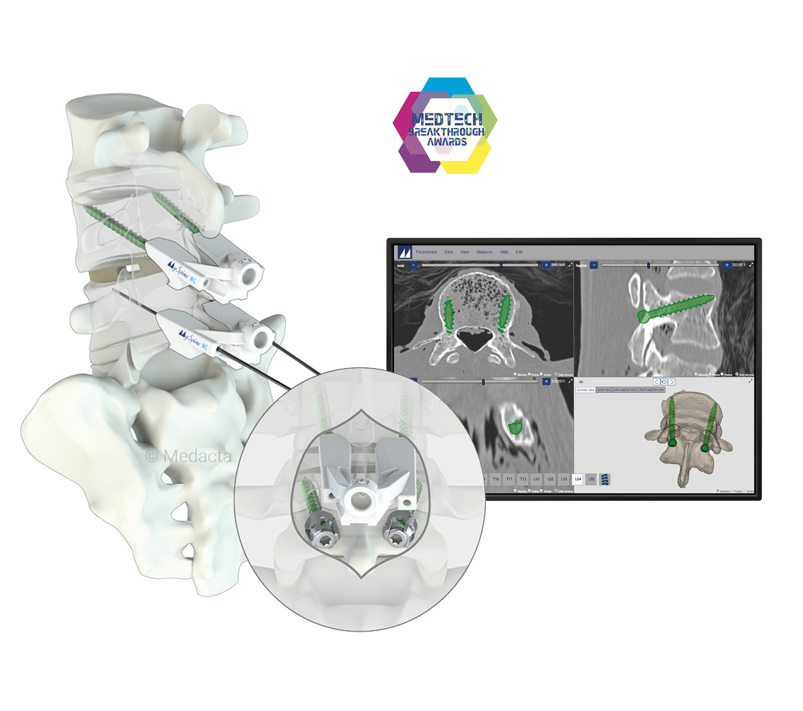 Medacta Corporate | MySpine MC